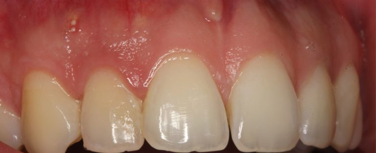 Cirugía periapical, el último paso antes de extraer el diente | IDIM ...